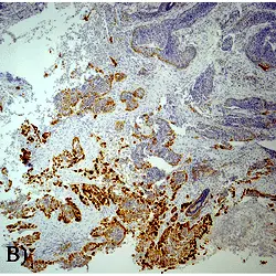 p16 staining patterns. | Record | DigitalNZ