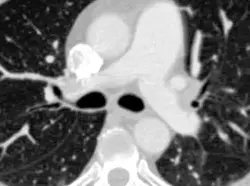 A Patient Based Model of pulmonary embolism | Record | DigitalNZ